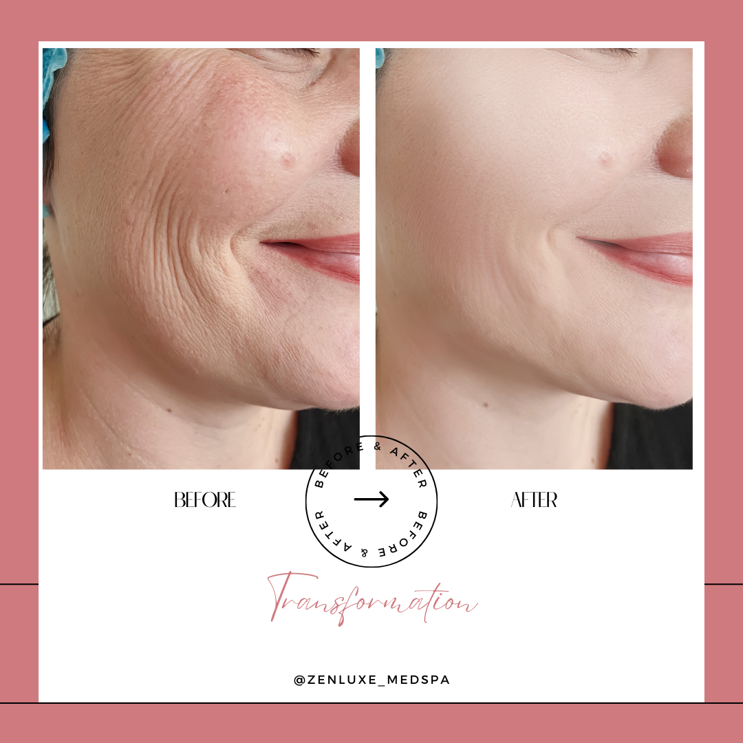 Before and After Botox Gallery - Zen Luxe Medspa & IV Lounge