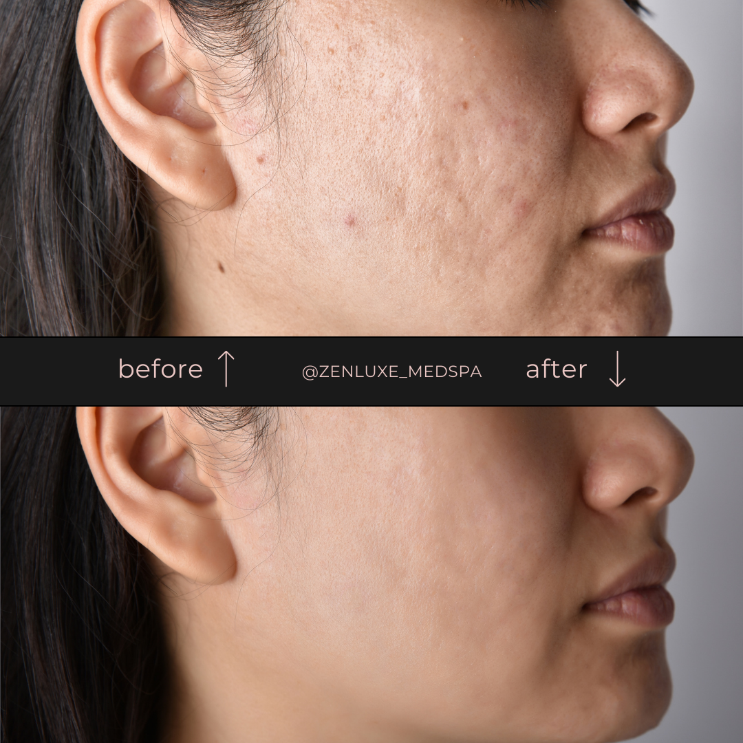 Before and After Laser Gallery - Zen Luxe Medspa & IV Lounge