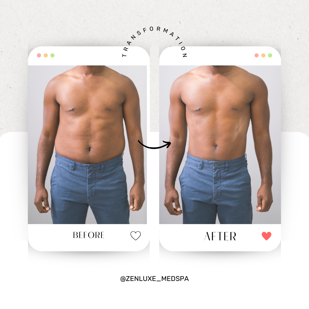 Before and After Men Treatment Gallery - Zen Luxe Medspa & IV Lounge