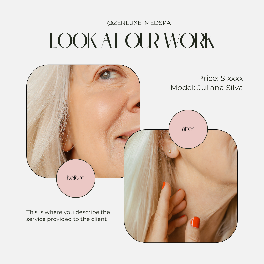 Before and After PDO Threads Gallery - Zen Luxe Medspa & IV Lounge